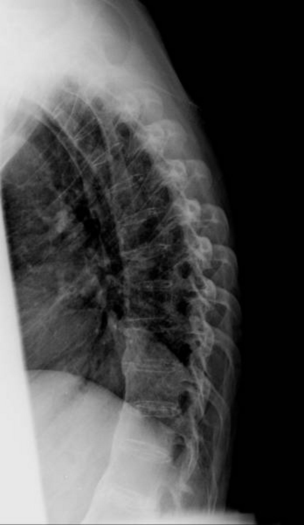 HLA-B27 assoziierte Spondyloarthritis (M. Bechterew) | Department für ...