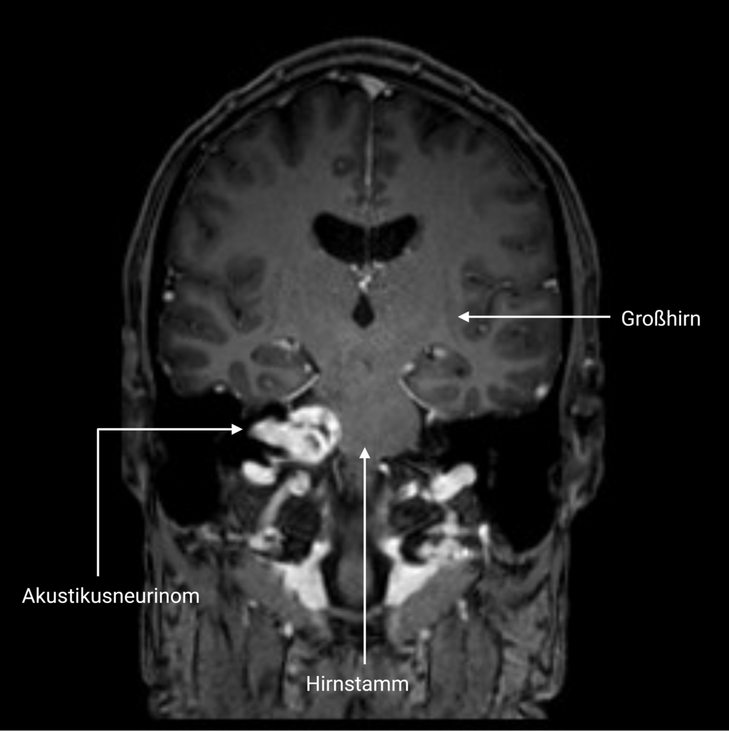 Akustikusneurinom | Universitätsklinik und Poliklinik für ...